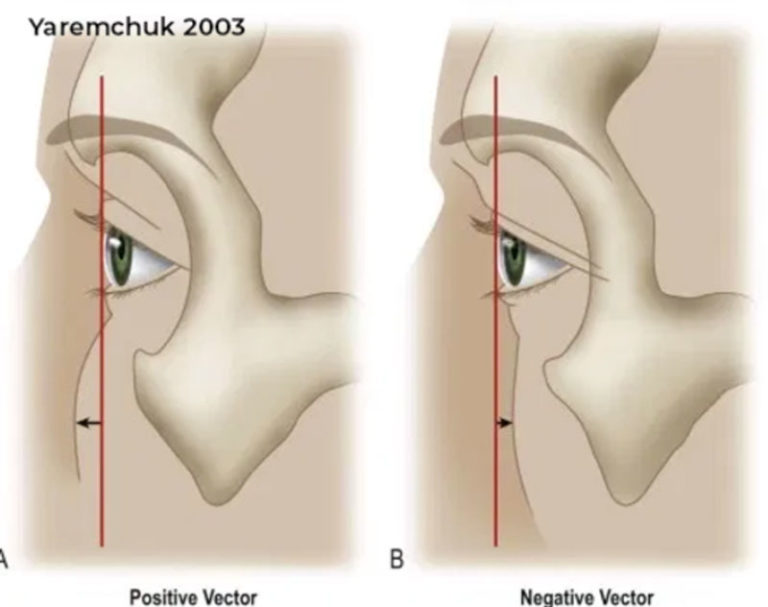 Cosmetic Orbital Decompression Surgery NJ | Center for Eye & Facial ...