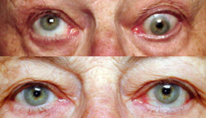 Eyelid & Eye Muscle Surgery NJ | Center for Eye & Facial Plastic Surgery