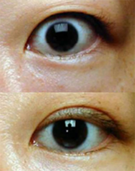 Eyelid & Eye Muscle Surgery NJ | Center for Eye & Facial Plastic Surgery