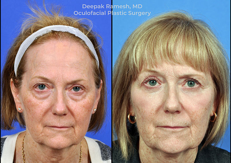 Skin Resurfacing in New Jersey | Center for Eye & Facial Plastic Surgery