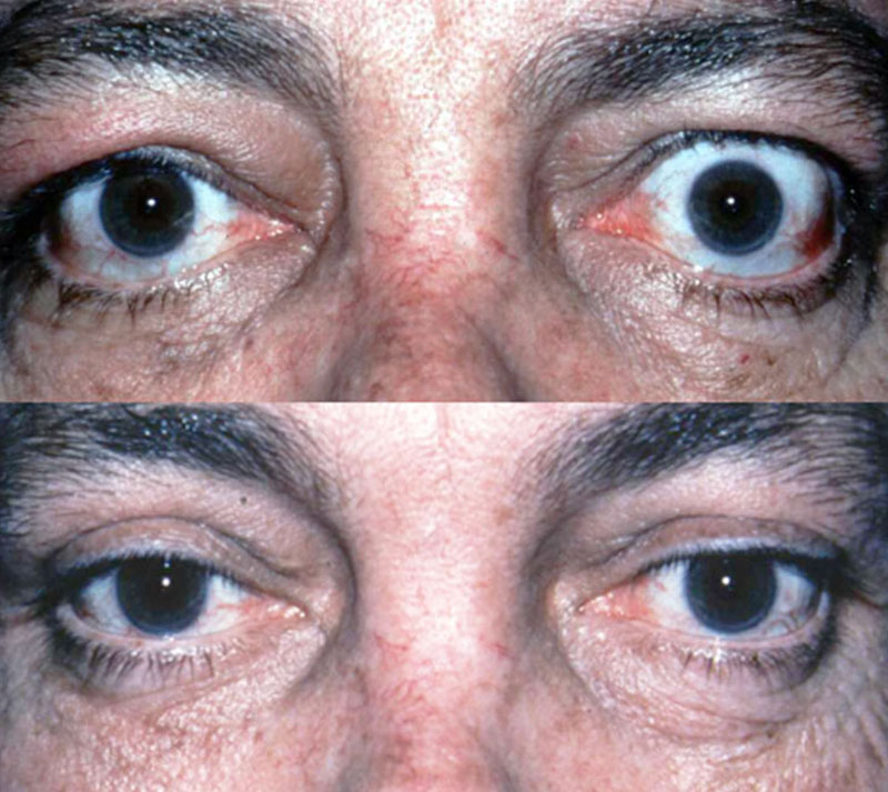 Cosmetic Orbital Decompression Surgery NJ | Center for Eye & Facial ...