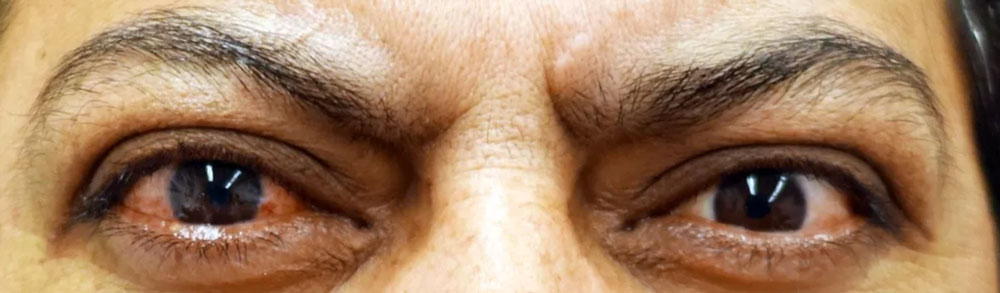 Tepezza - Center for Eye and Facial Plastic Surgery