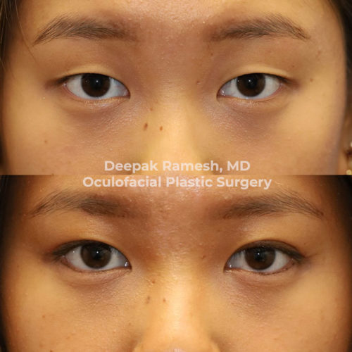 Asian Eyelid Surgery in NJ | Center for Eye & Facial