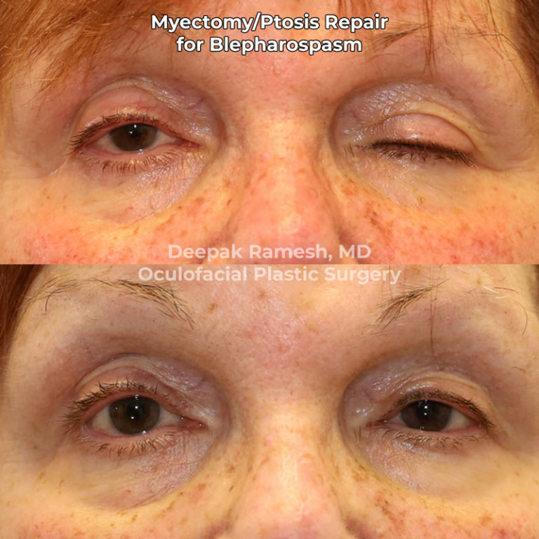Blepharospasm & Facial Spasm in NJ | Center for Eye & Facial