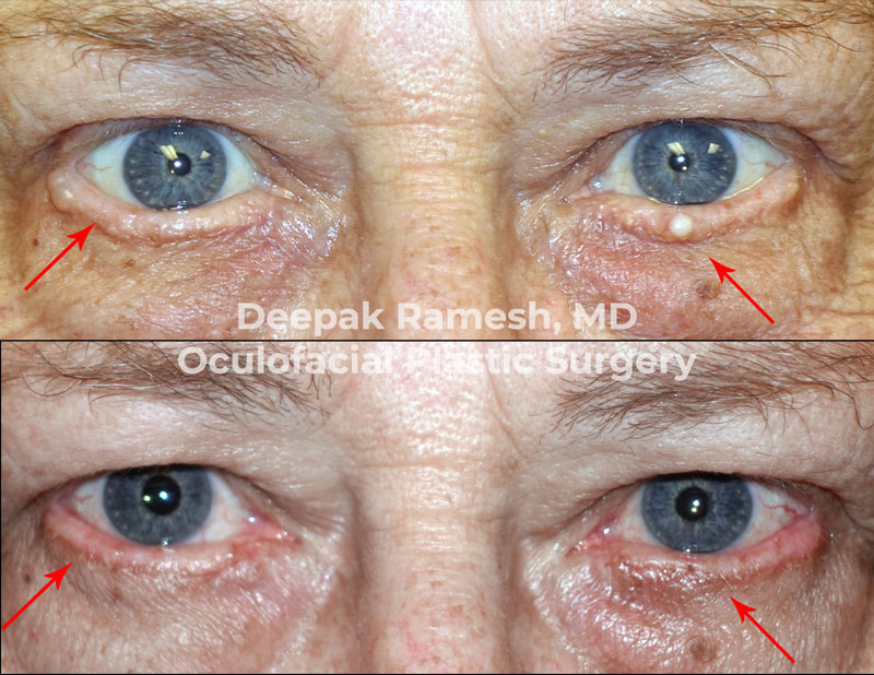 Lumps & Bumps in Somerset, NJ | Center for Eye & Facial