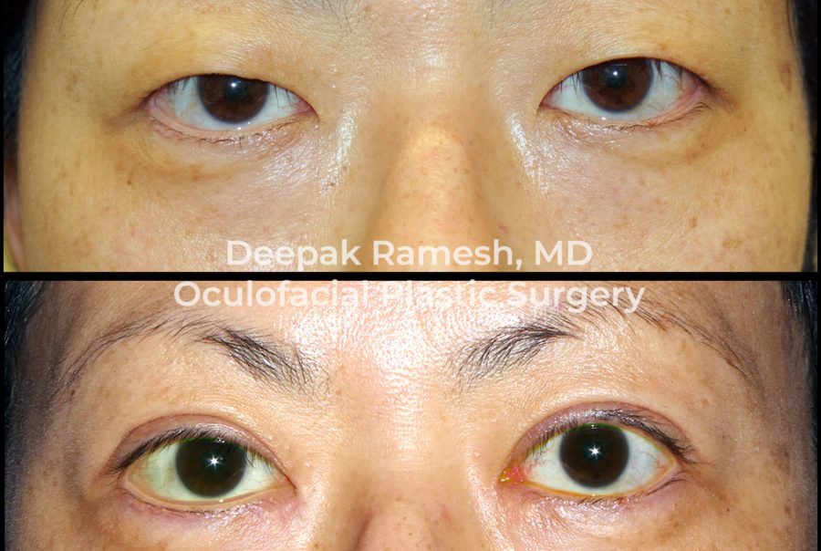 Crease-Formation Archives - Center for Eye and Facial Plastic Surgery