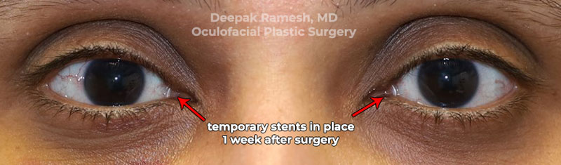 Tearing & Lacrimal Disorders Somerset, NJ