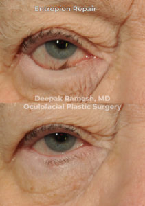 Eyelid Malpositions in Somerset, NJ | Center for Eye & Facial