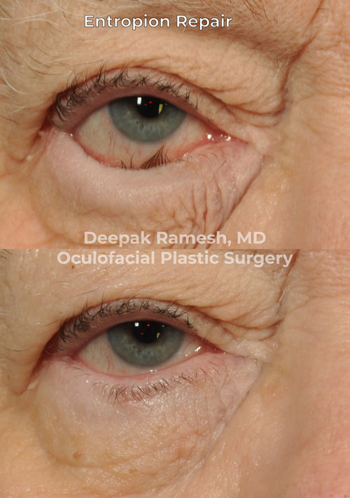 Eyelid Malpositions in Somerset, NJ | Center for Eye & Facial