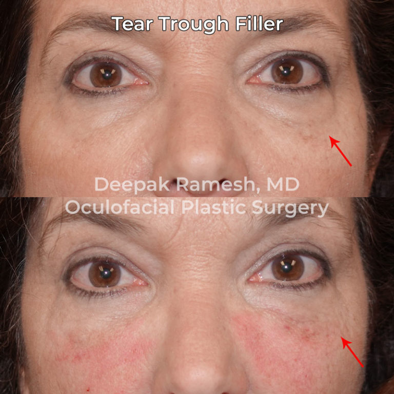 Dermal Fillers Somerset, NJ | Center For Eye and Facial Plastic Surgery