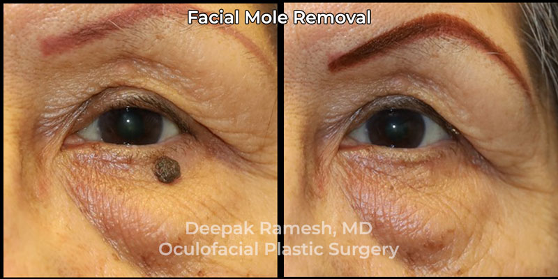 Lumps & Bumps in Somerset, NJ | Center for Eye & Facial