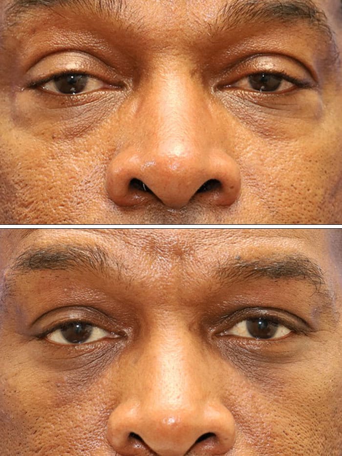 Eyelid Bag Surgery in New Jersey | Dr. Deepak Ramesh