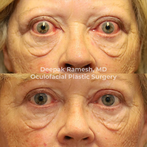 Tepezza in Somerset, NJ | Center for Eye & Facial Plastic Surgery