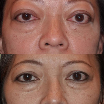 Tepezza in Somerset, NJ | Center for Eye & Facial Plastic Surgery