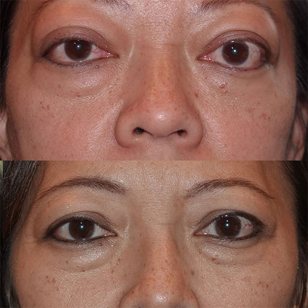 Tepezza in Somerset, NJ | Center for Eye & Facial Plastic Surgery