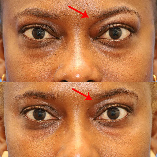 Tepezza in Somerset, NJ | Center for Eye & Facial Plastic Surgery