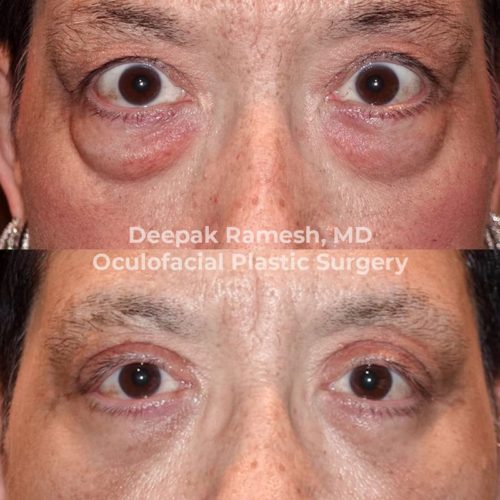 Orbital Decompression - Center for Eye and Facial Plastic Surgery