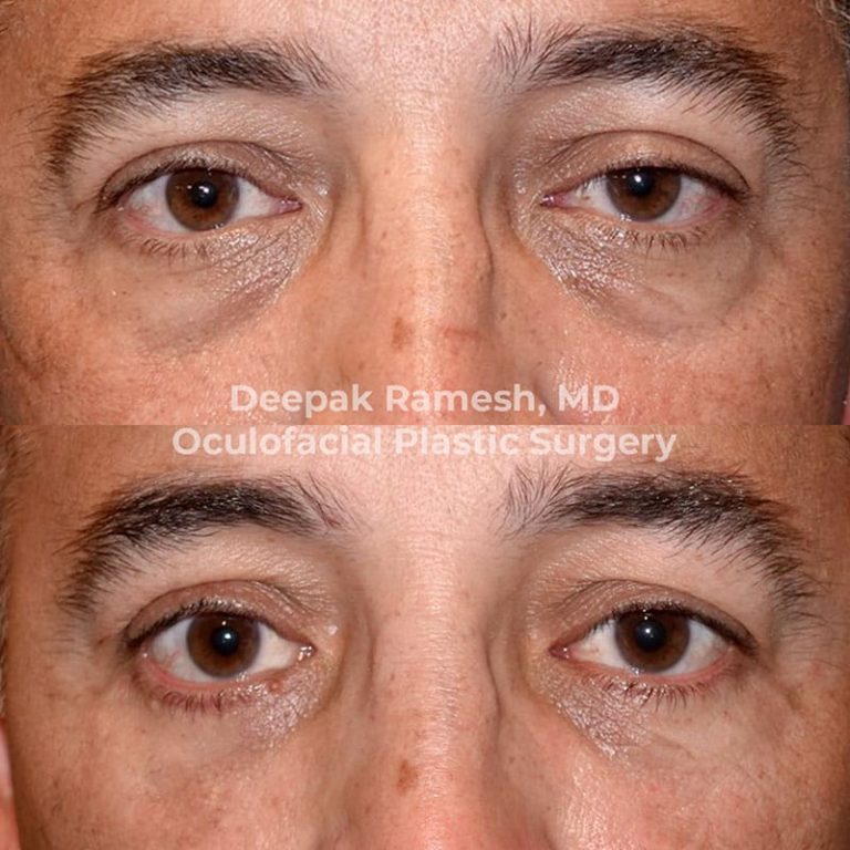 Male Surgery - Center for Eye and Facial Plastic Surgery