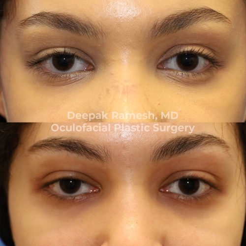 Orbital Decompression - Center for Eye and Facial Plastic Surgery