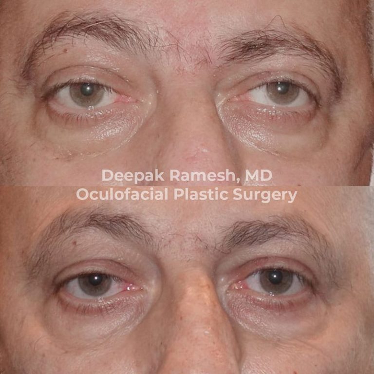 Tepezza - Center for Eye and Facial Plastic Surgery