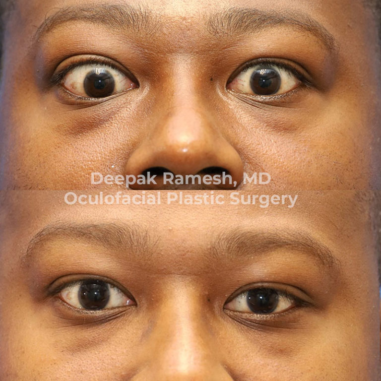 Tepezza - Center for Eye and Facial Plastic Surgery