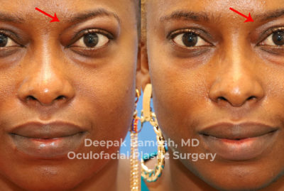 Tepezza Archives - Center for Eye and Facial Plastic Surgery