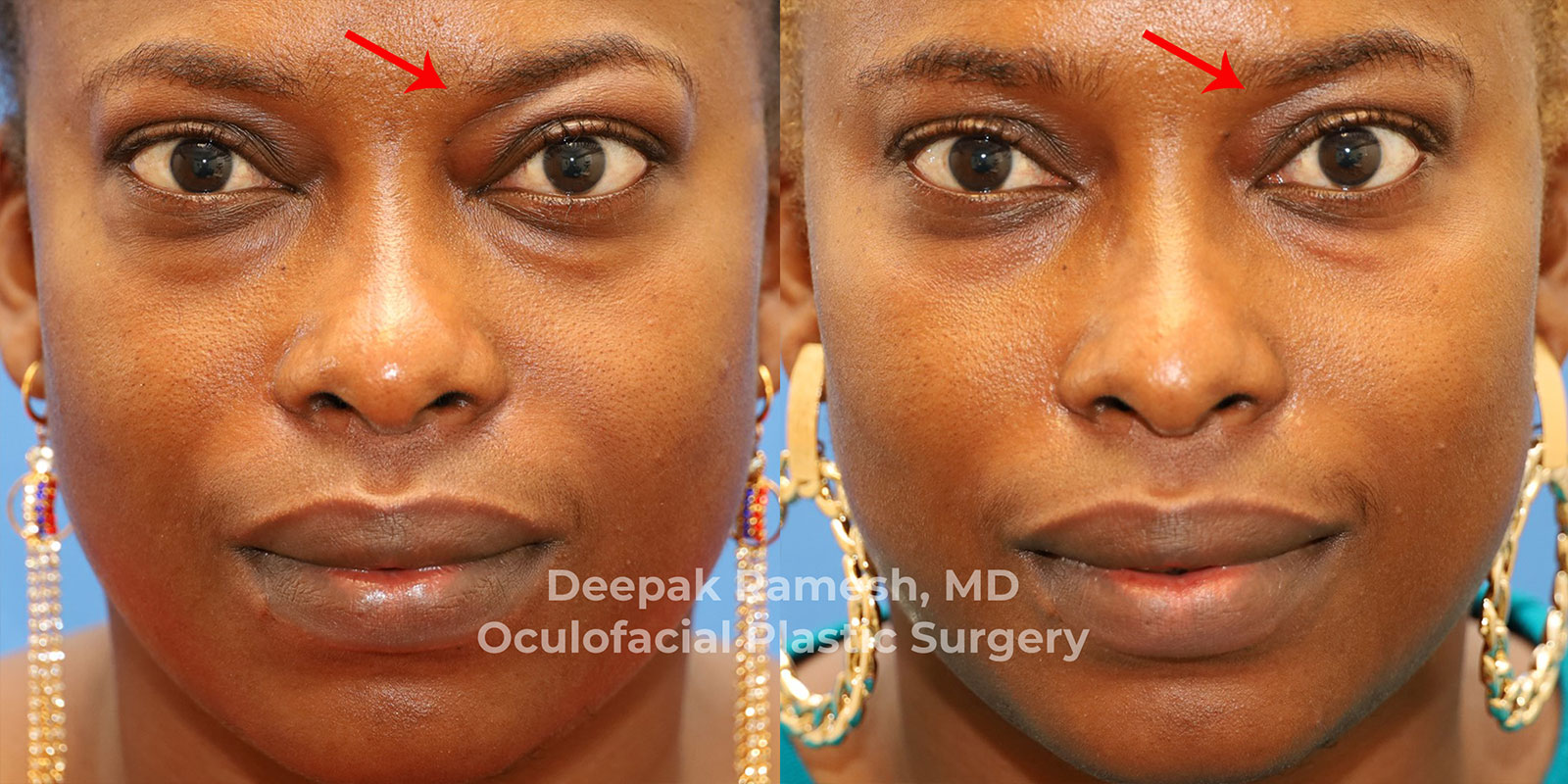 Tepezza - Center for Eye and Facial Plastic Surgery