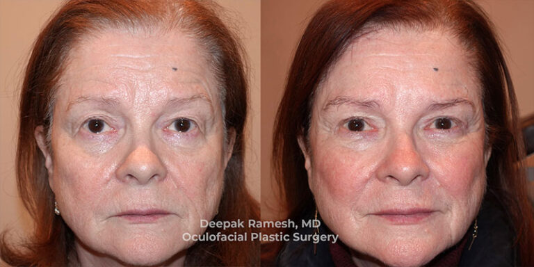 Face & Neck Surgery - Center for Eye and Facial Plastic Surgery