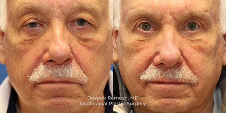 Male Surgery - Center for Eye and Facial Plastic Surgery