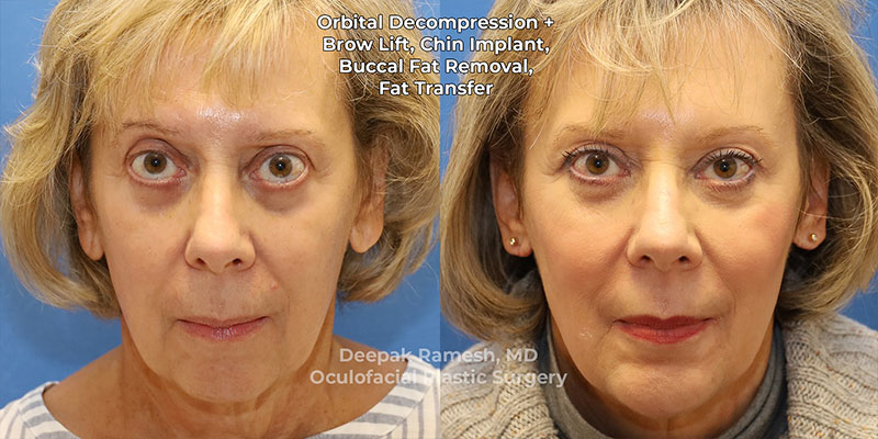 Oculoplastic Surgeon in NJ | The Center for Eye & Facial Plastic Surgery