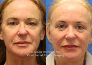 Face & Neck Surgery - Center for Eye and Facial Plastic Surgery
