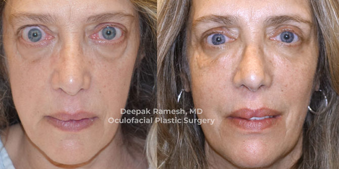 Orbital Decompression - Center for Eye and Facial Plastic Surgery