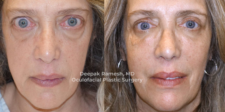 Orbital Decompression - Center for Eye and Facial Plastic Surgery