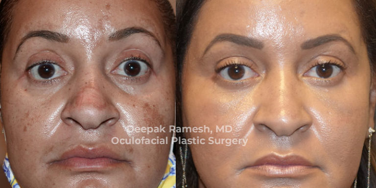 Orbital Decompression - Center for Eye and Facial Plastic Surgery