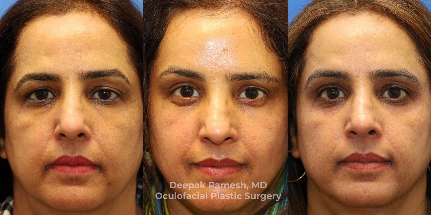 Eyebrow Lift in New Jersey | Brow Lift | Center for Eye & Facial