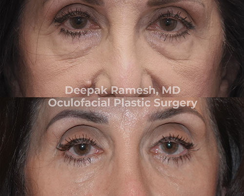 Fat Transfer Archives - Center for Eye and Facial Plastic Surgery