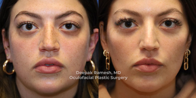 Orbital Decompression - Center for Eye and Facial Plastic Surgery