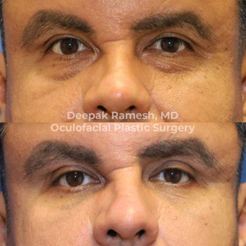Male Surgery - Center for Eye and Facial Plastic Surgery
