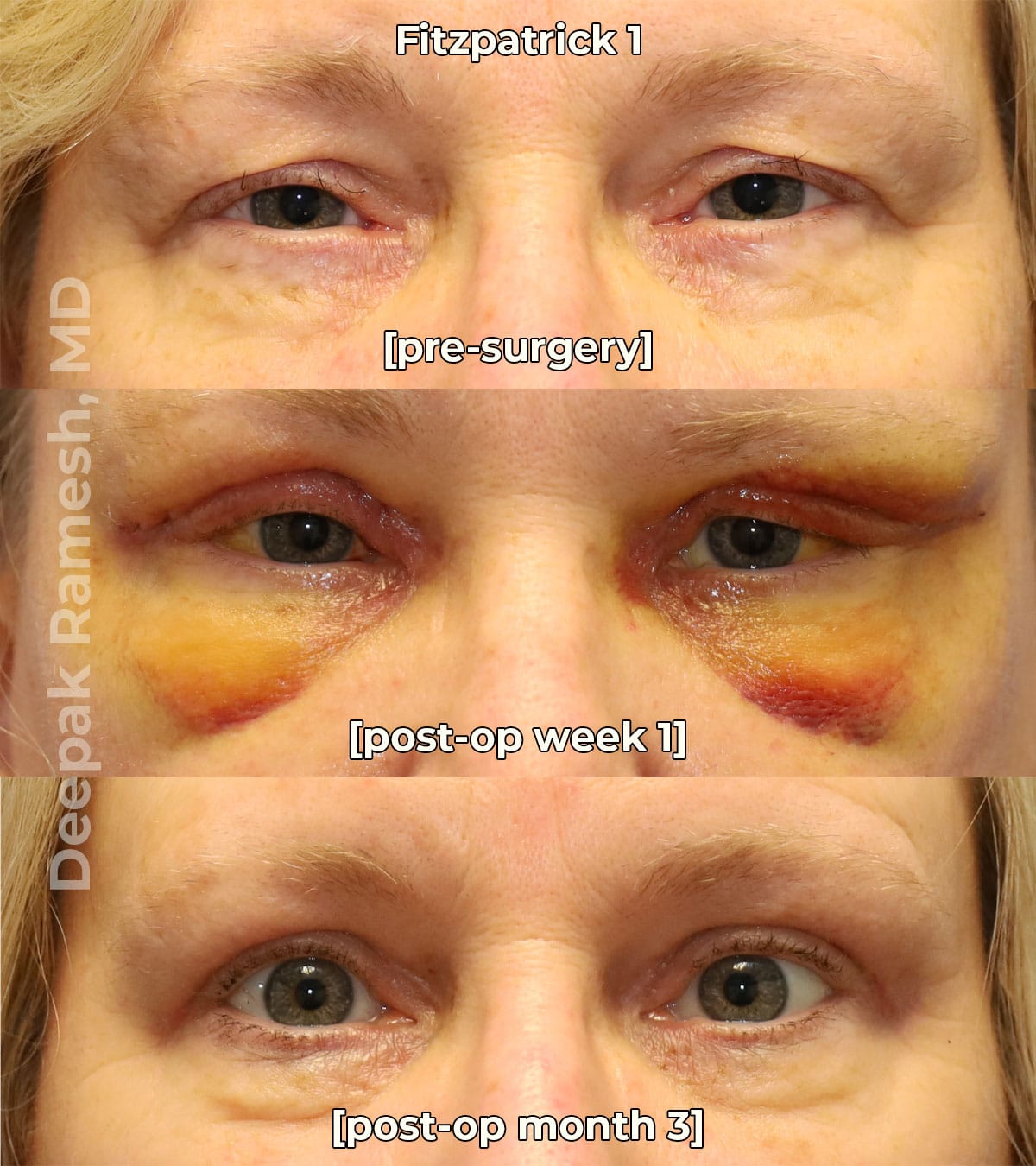 Blepharoplasty Healing Online Blepharoplasty Healing Online