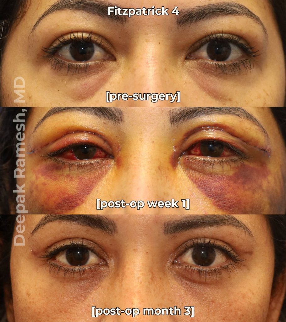 Recovery from Eyelid Surgery New Jersey | Dr. Deepak Ramesh