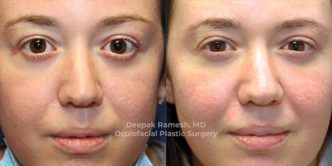 Orbital Decompression - Center for Eye and Facial Plastic Surgery