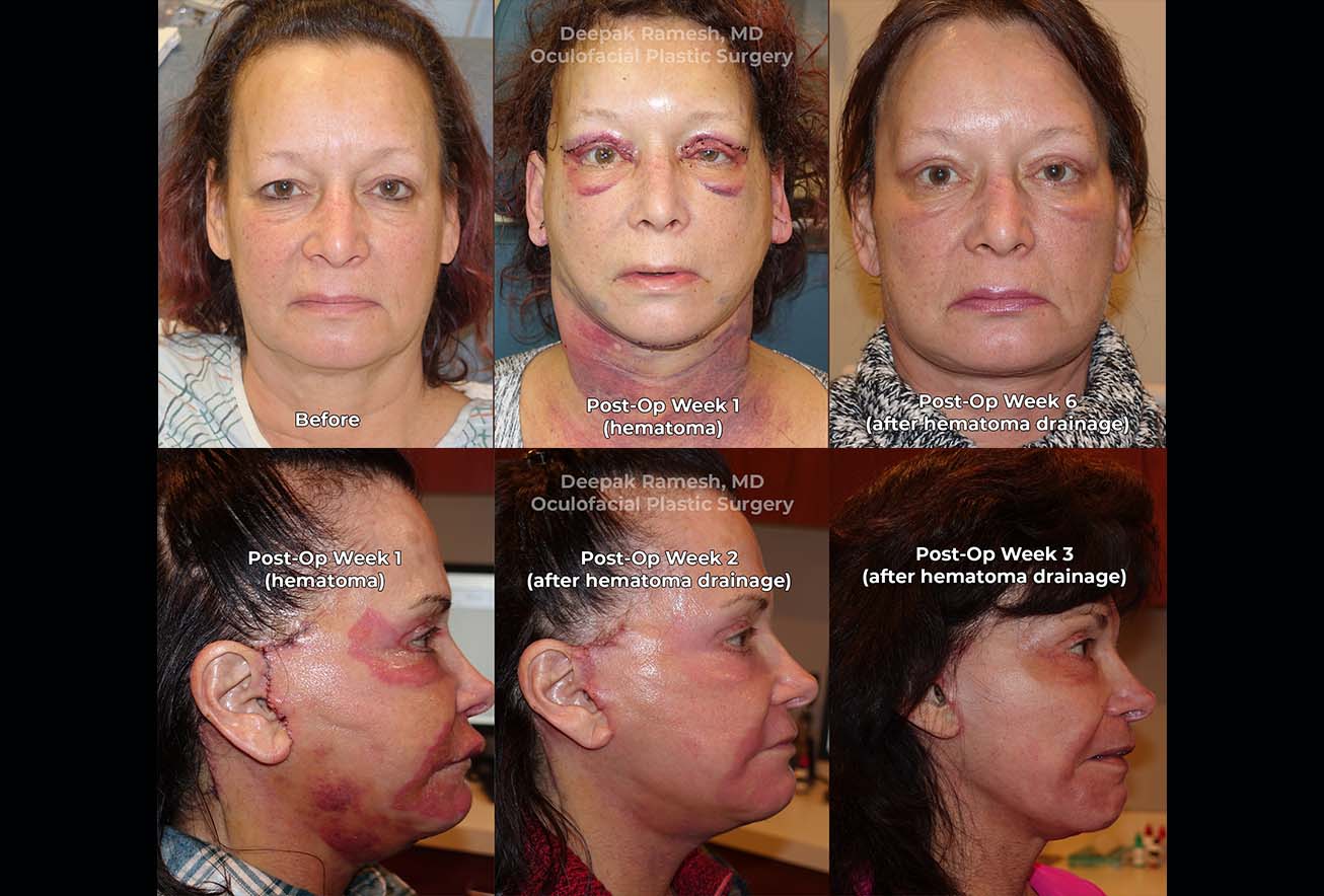 Recovery from Face/Neck Lift New Jersey | Center for Eye & Facial Plastics