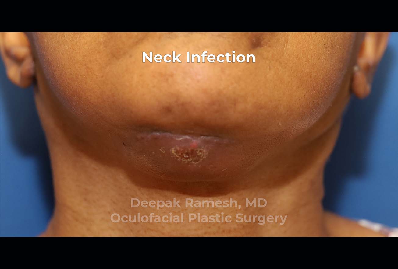 Recovery from Face/Neck Lift New Jersey | Center for Eye & Facial Plastics