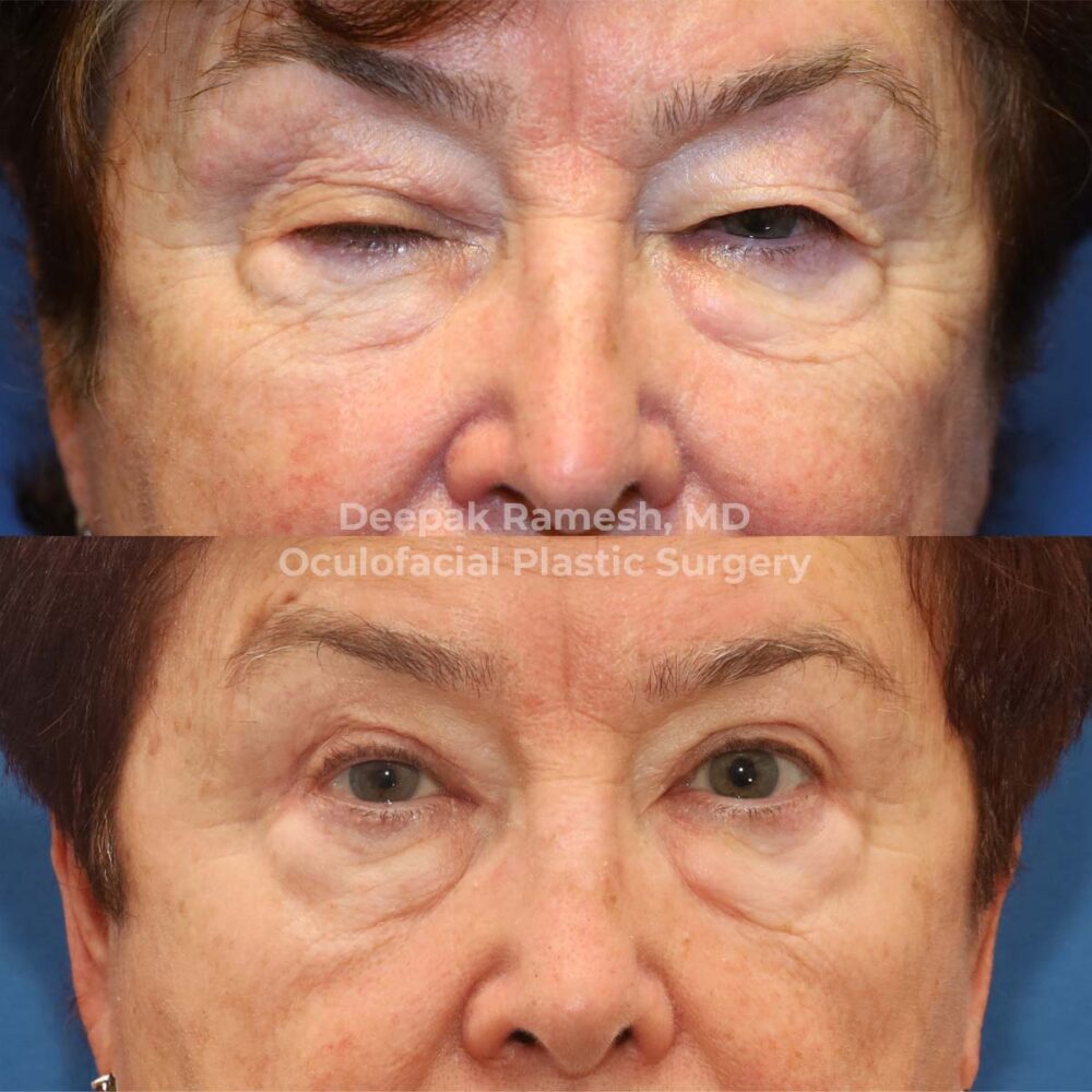 Eyelid & Eyebrow Lift - Center for Eye and Facial Plastic Surgery