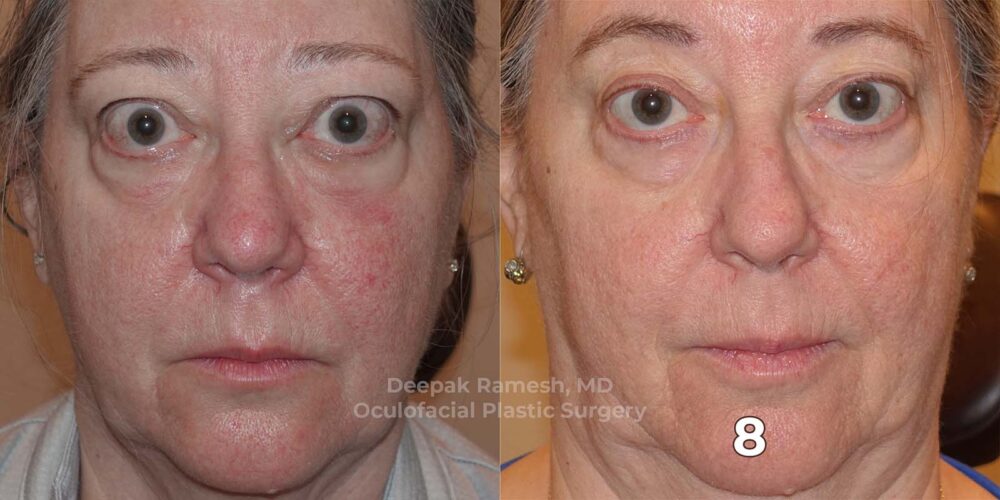 Tepezza - Center for Eye and Facial Plastic Surgery