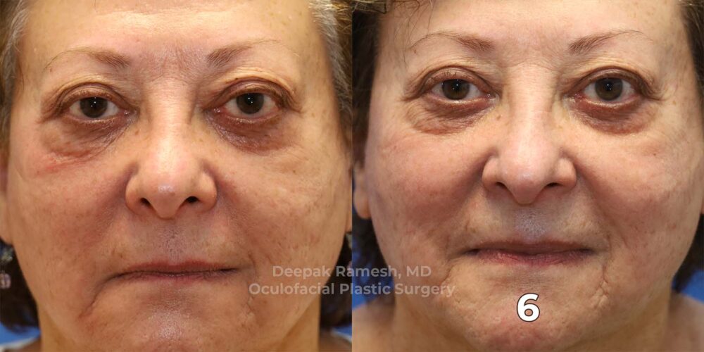 Tepezza - Center for Eye and Facial Plastic Surgery