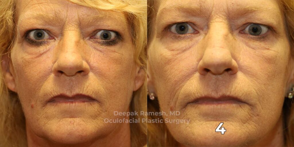 Tepezza - Center for Eye and Facial Plastic Surgery