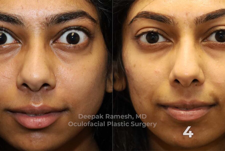 Tepezza Archives - Center for Eye and Facial Plastic Surgery