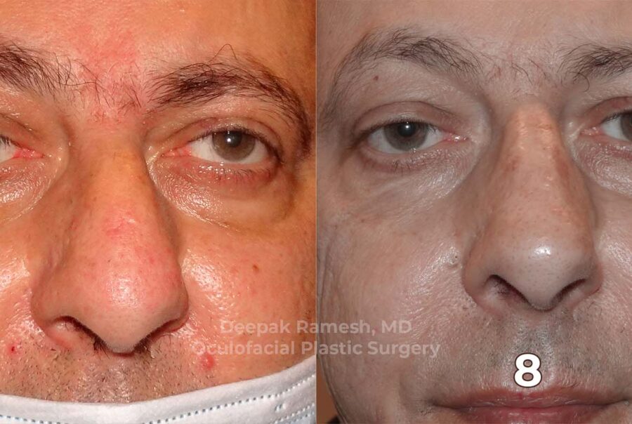 Tepezza Archives - Center for Eye and Facial Plastic Surgery