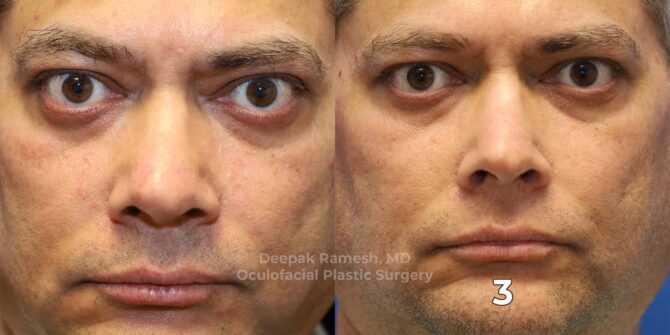 Tepezza - Center for Eye and Facial Plastic Surgery